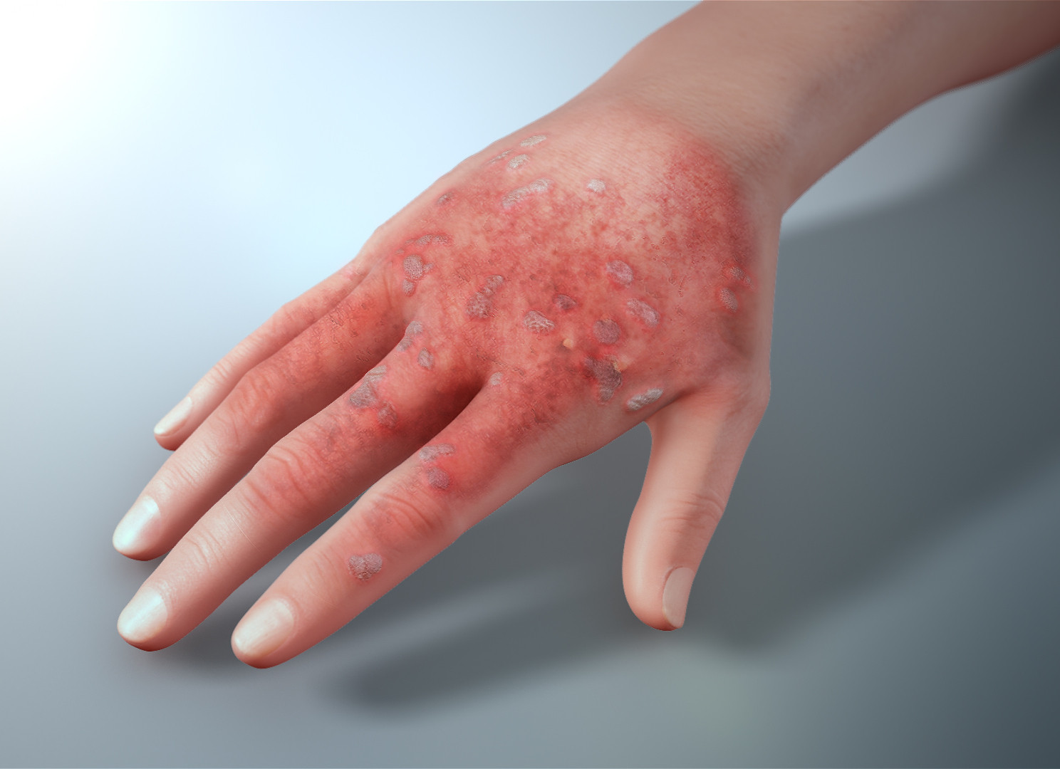 Actinic Keratoses Relief | Expert Dermatologists | DermaSpaMed