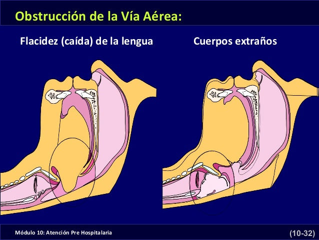Obstrucción de las vías aéreas