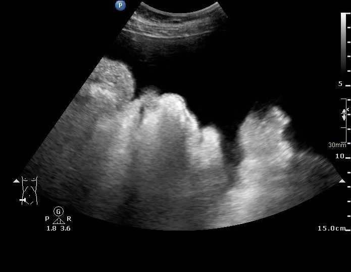 Ascites Drain | Angiography and Intervention