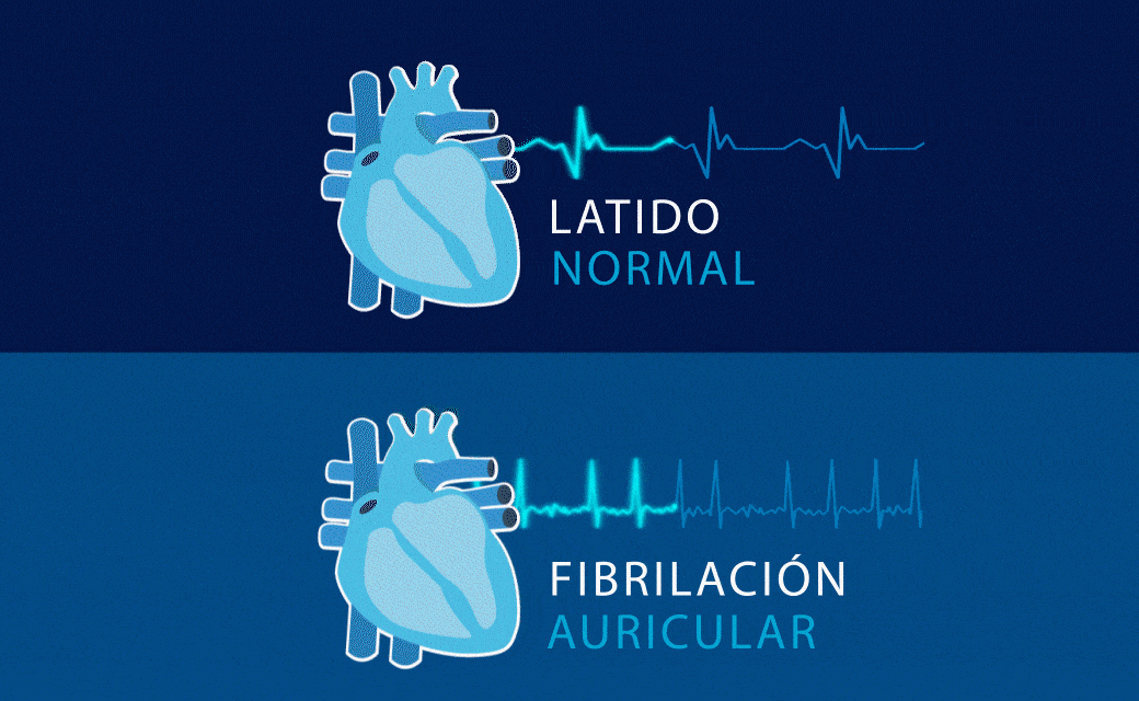 Fibrilacao Ventricular Gif