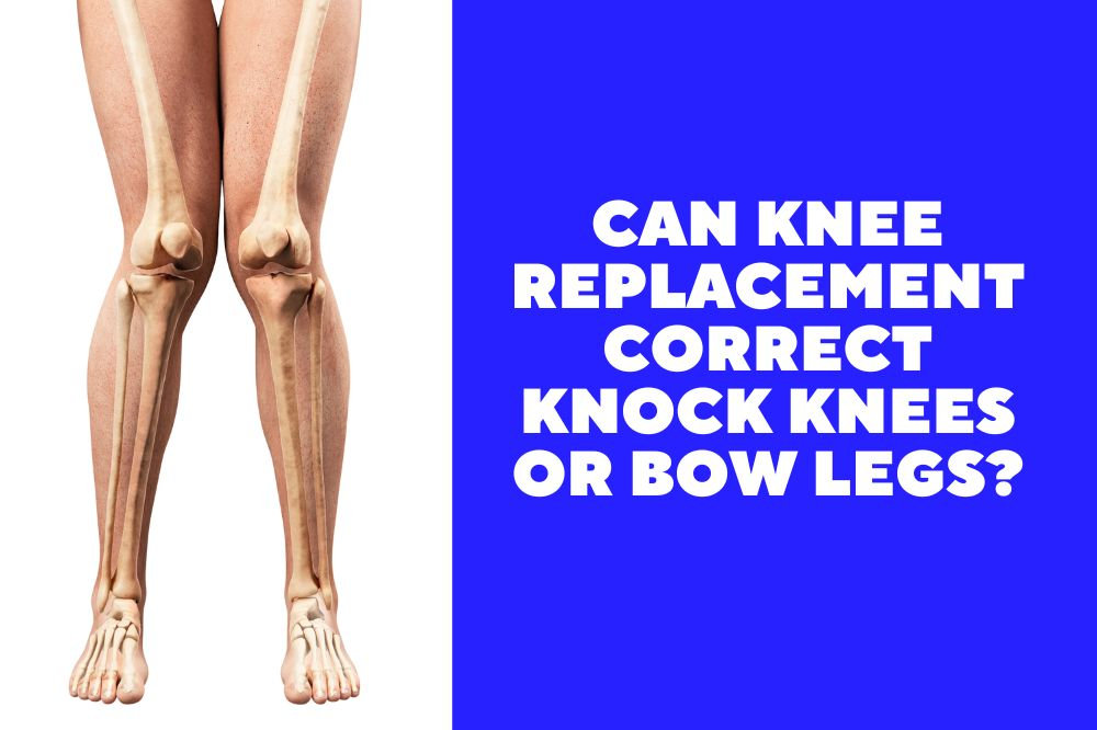 Can Knee Replacement Correct Knock Knees or Bow Legs?