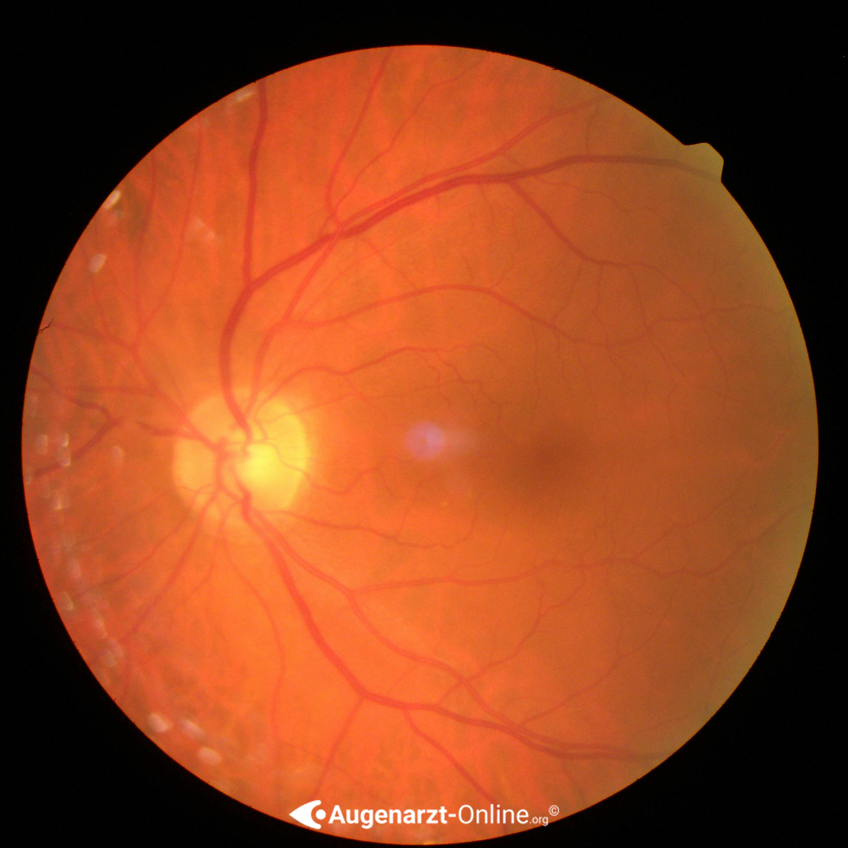 Hollenhorst Plaque | Atlas der Augenheilkunde