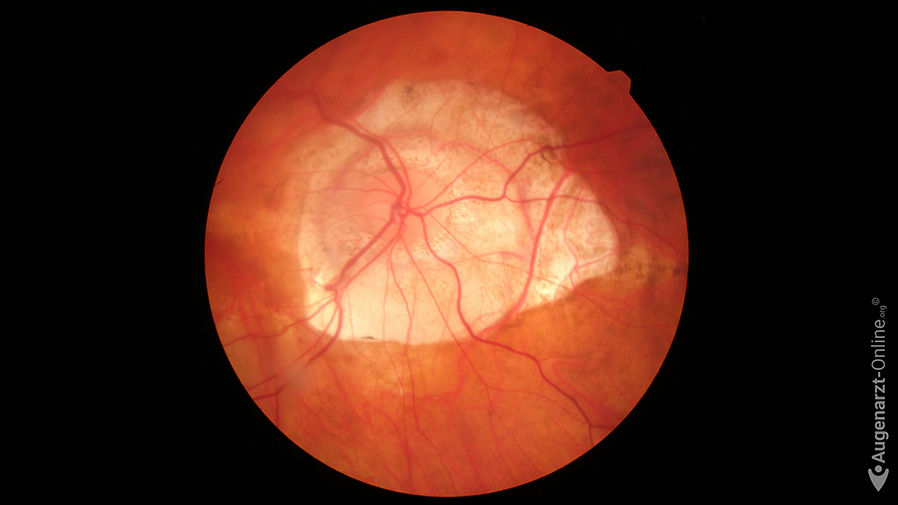 Conus myopicus | Atlas der Augenheilkunde