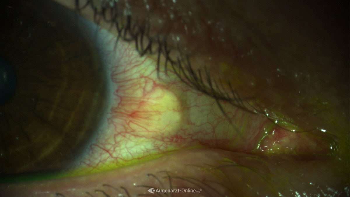 Bauernauge (Pingueculum) | Atlas der Augenheilkunde