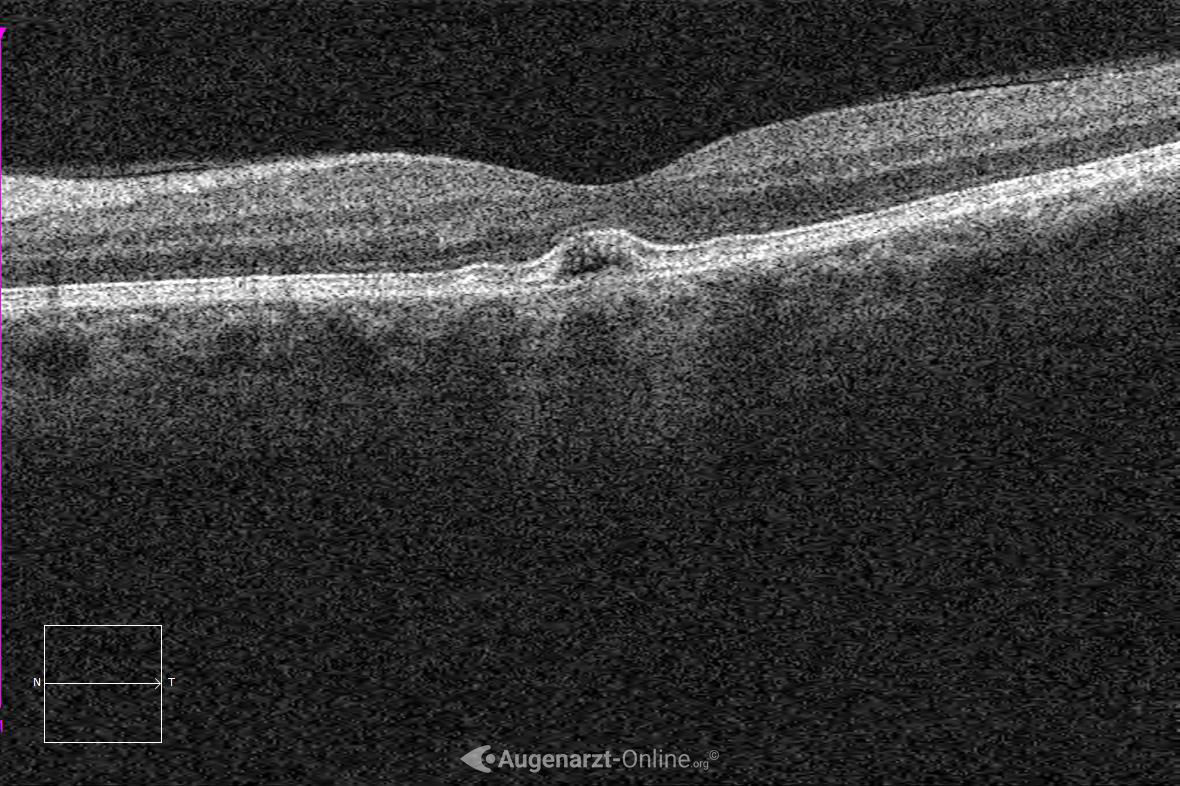 Vitelliforme Makuladystrophie | Atlas der Augenheilkunde