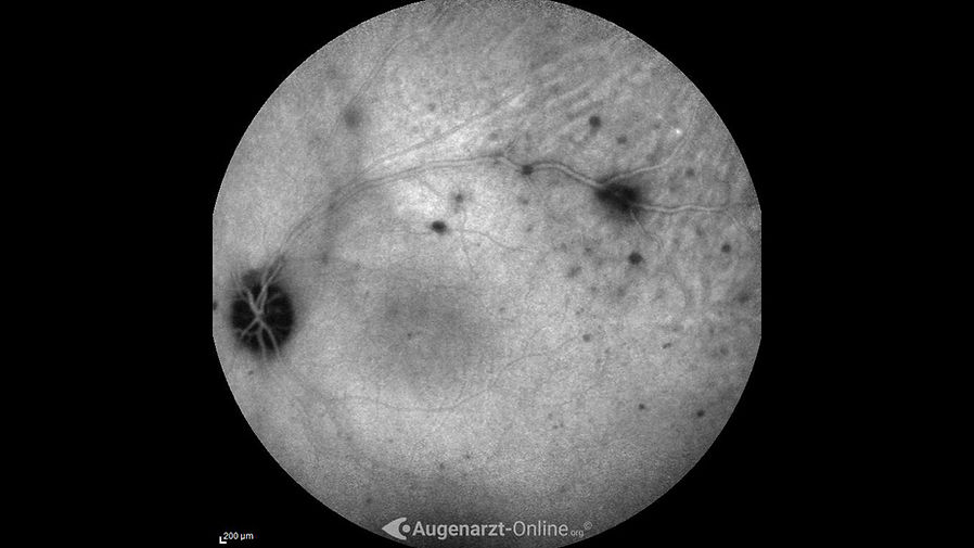 Candida Retinitis | Atlas der Augenheilkunde