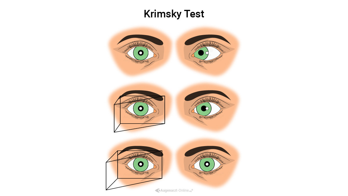 Krimsky-Test | Lexikon der Augenheilkunde