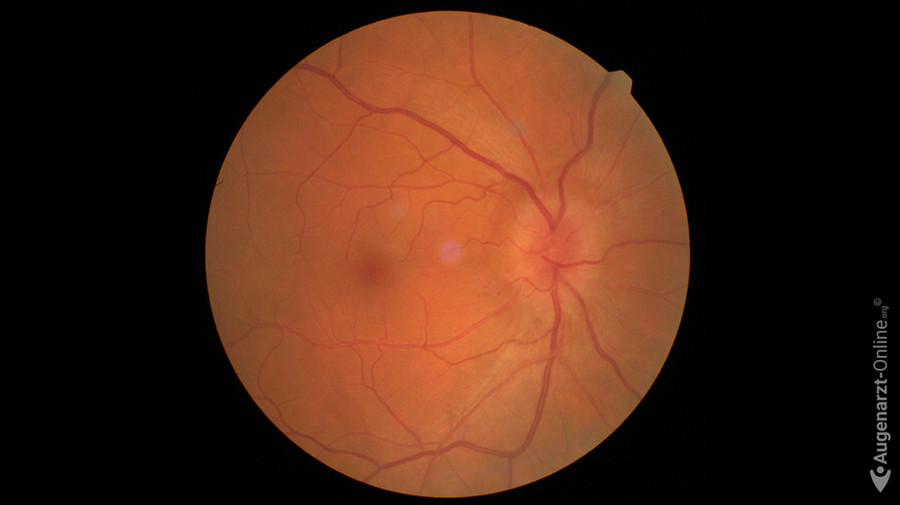 Papillenschwellung | Lexikon der Augenheilkunde