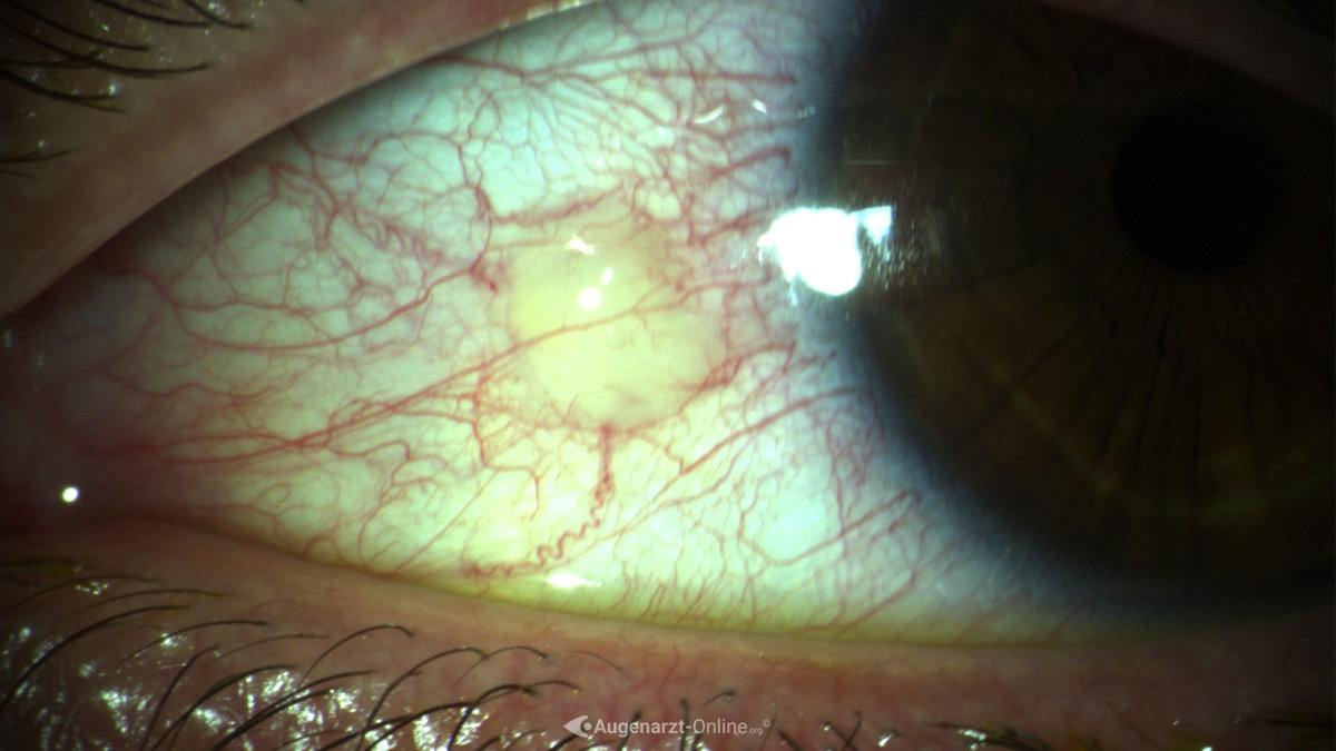 Pingueculum | Atlas der Augenheilkunde