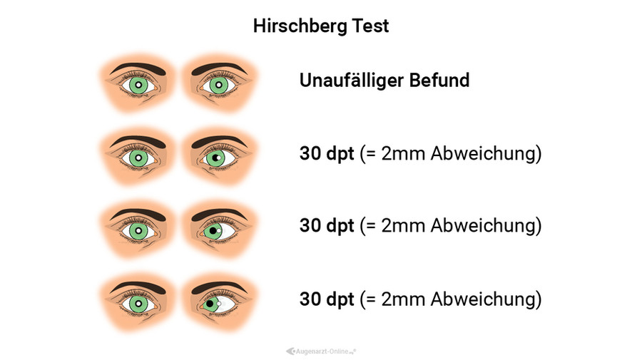Hirschberg -Test | Lexikon der Augenheilkunde