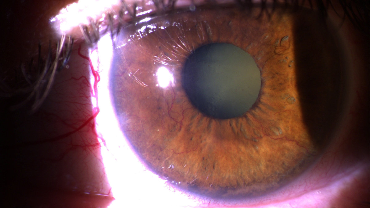 Rubeosis Iridis | Atlas der Augenheilkunde