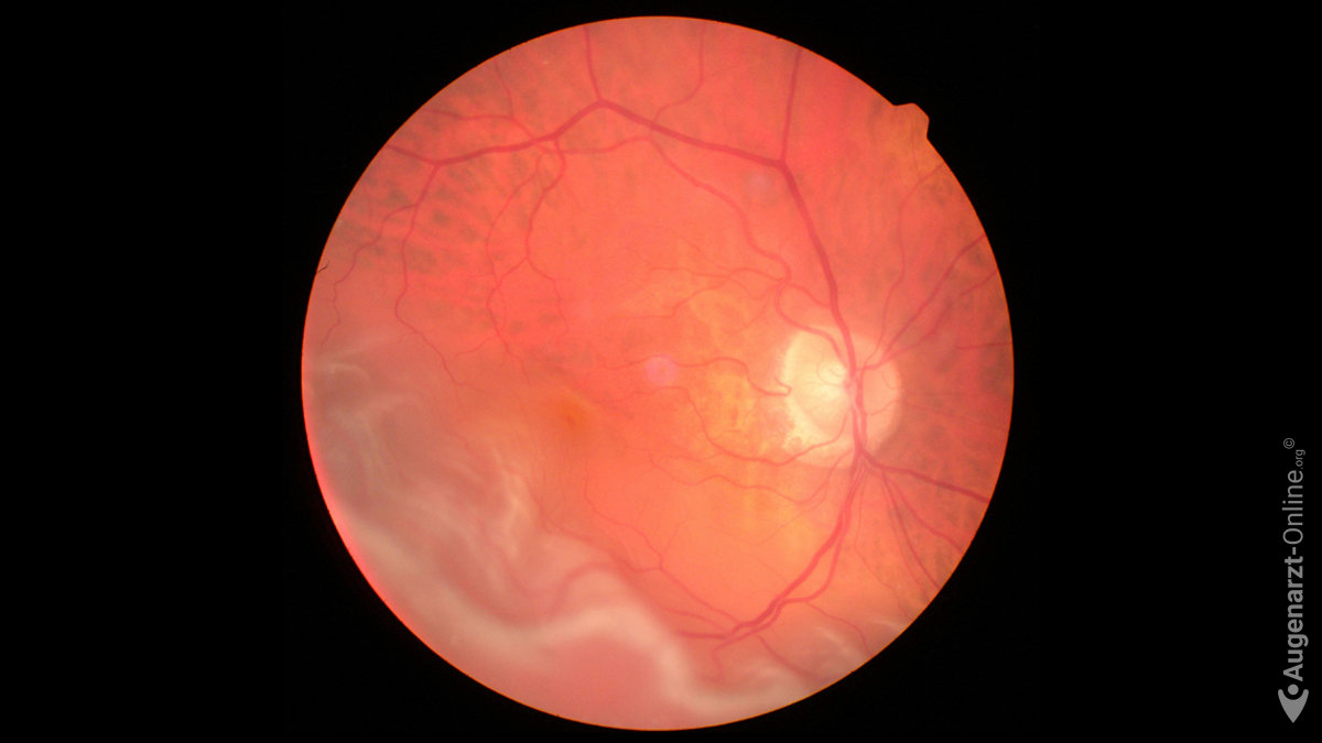 Ablatio retinae | Atlas der Augenheilkunde