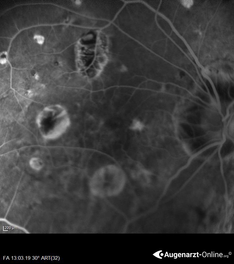 Fensterdefekte bei Myopia Magna | Atlas der Augenheilkunde