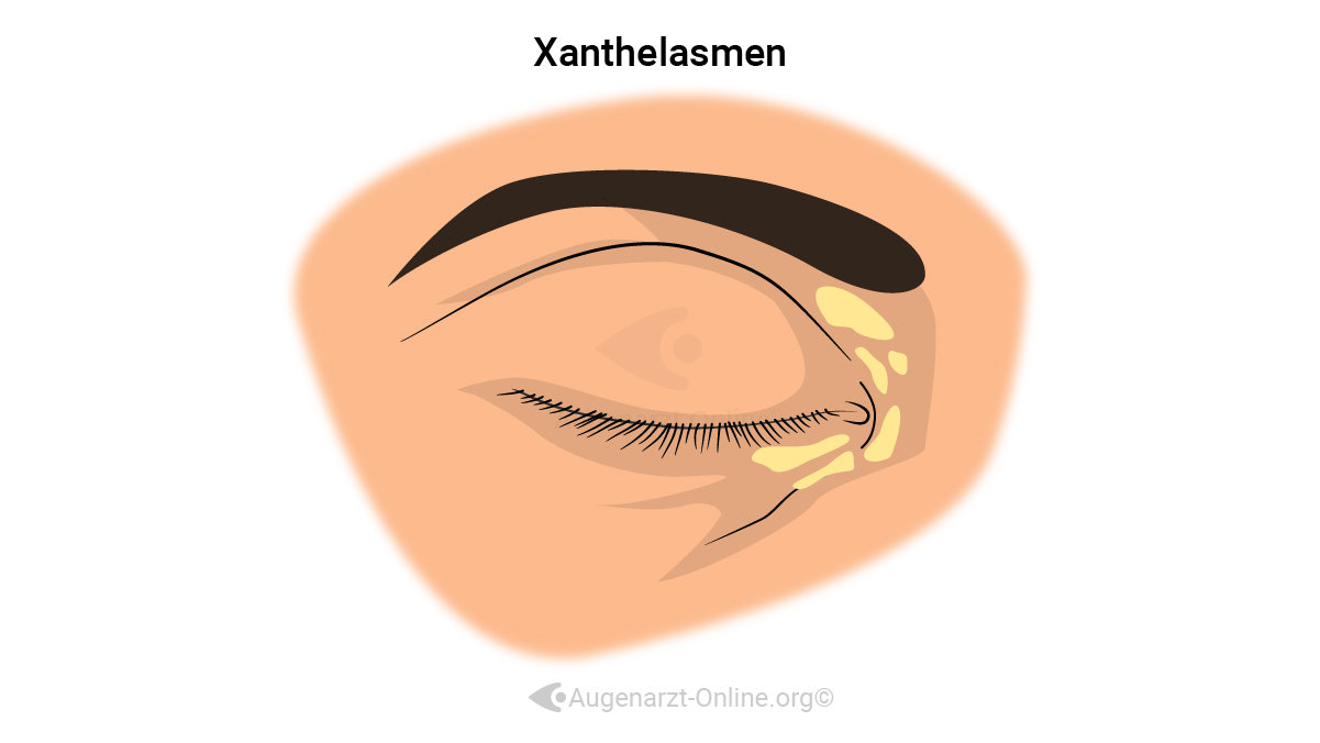 Xanthelasma | Lexikon der Augenheilkunde