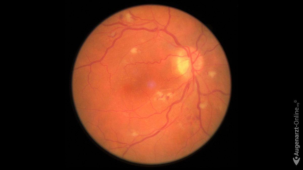 Hypertensive Retinopathie | Atlas der Augenheilkunde