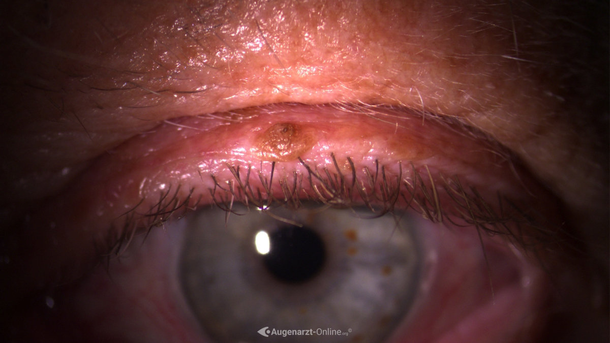 Hyperkeratose | Atlas der Augenheilkunde