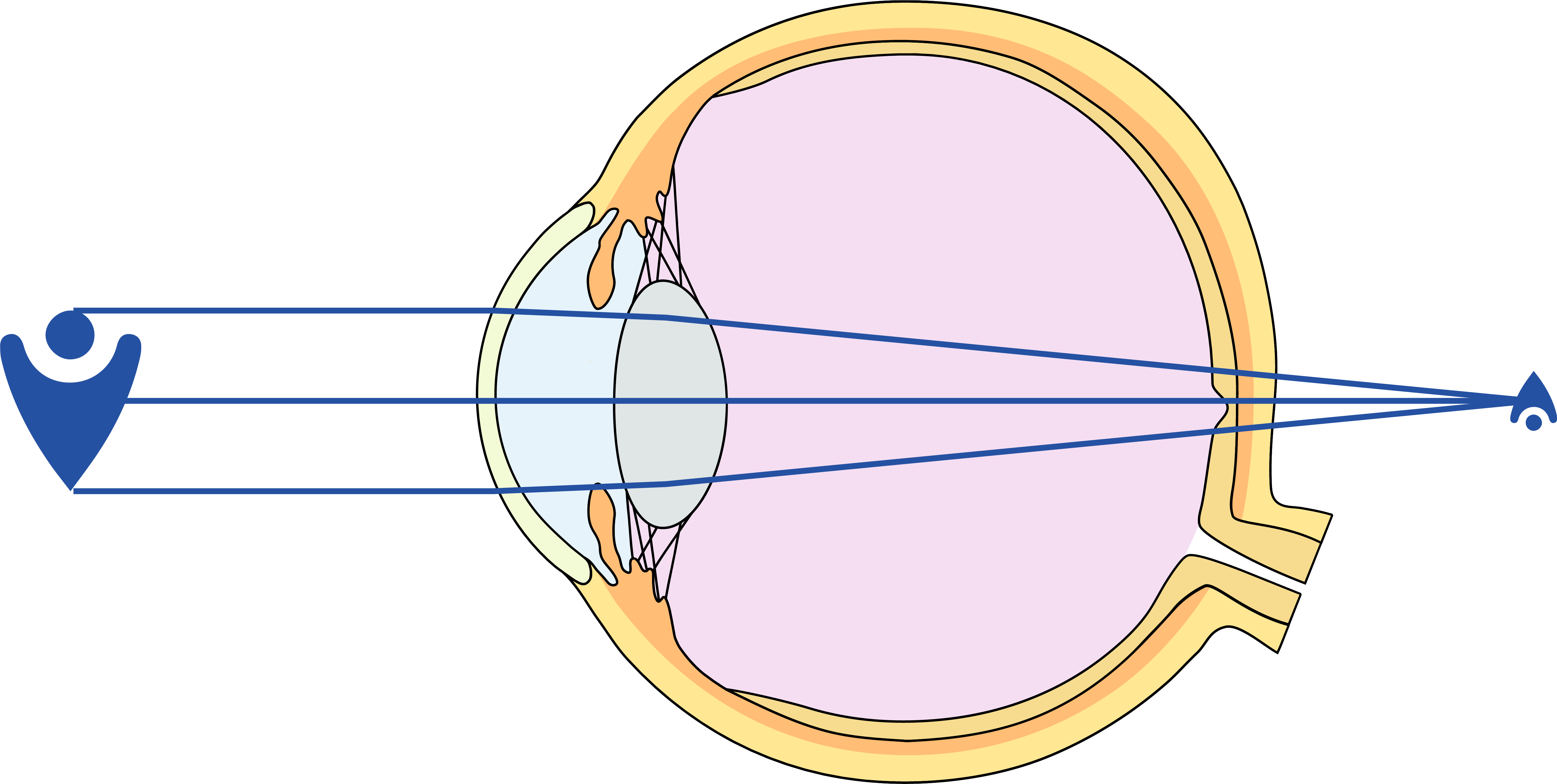 Weitsichtigkeit (Hyperopie) | Lexikon der Augenheilkunde