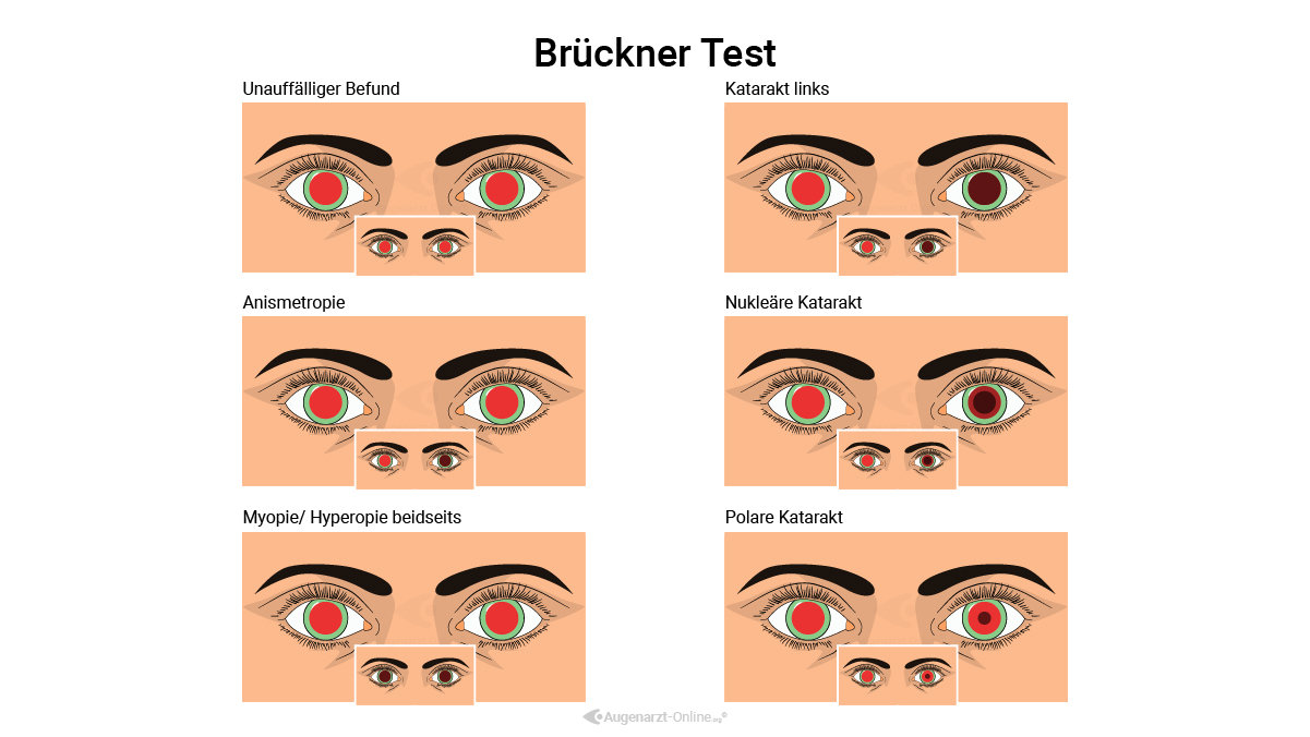 Brückner Test | Atlas der Augenheilkunde