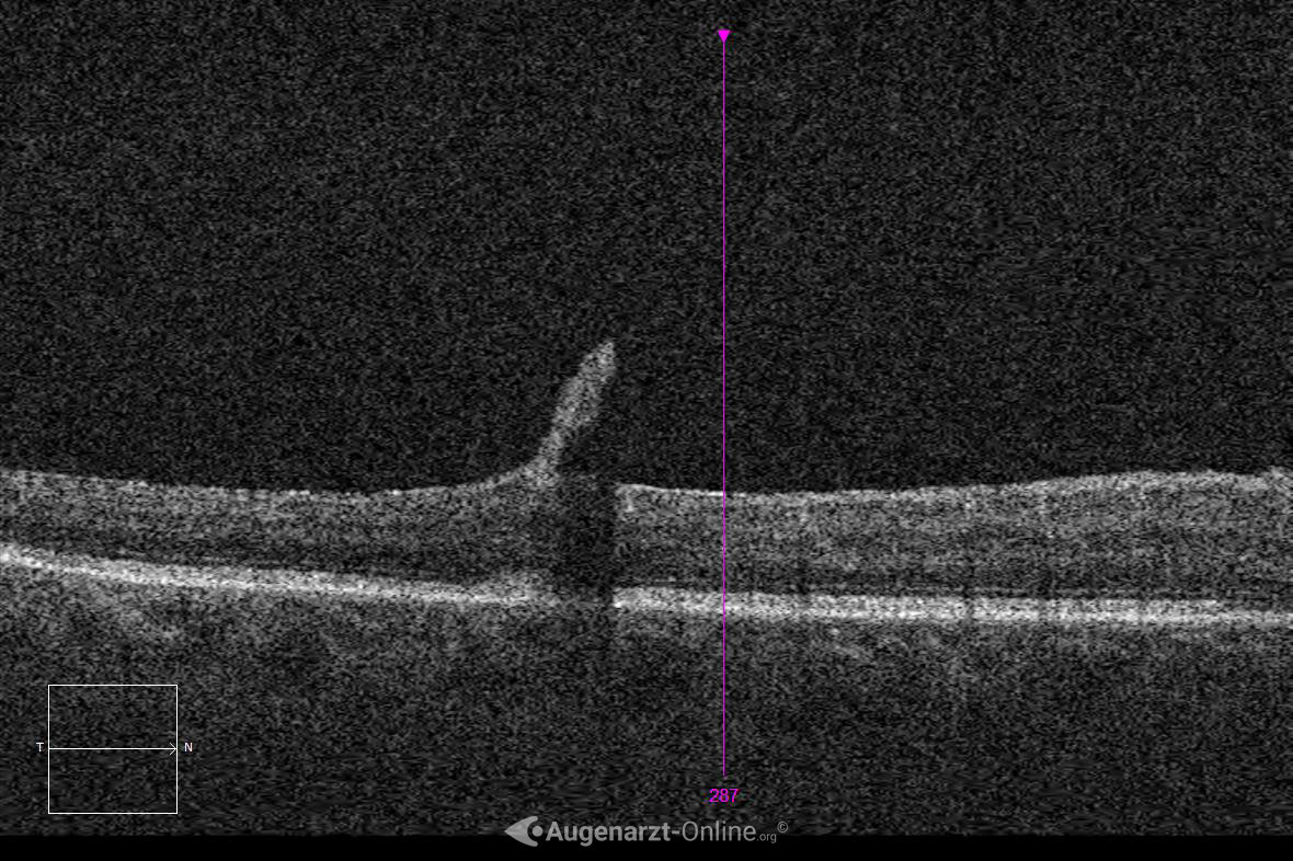 Gefäß-Proliferation | Atlas der Augenheilkunde