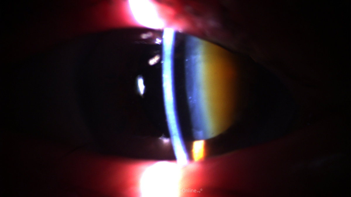 Cataracta brunescens | Atlas der Augenheilkunde