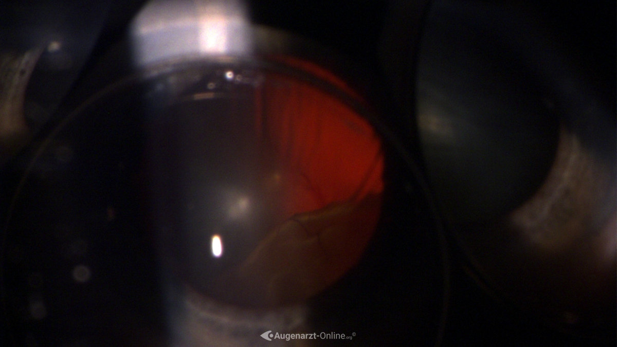 Ablatio Retinae Definition : Leitlinien – Altmersleben