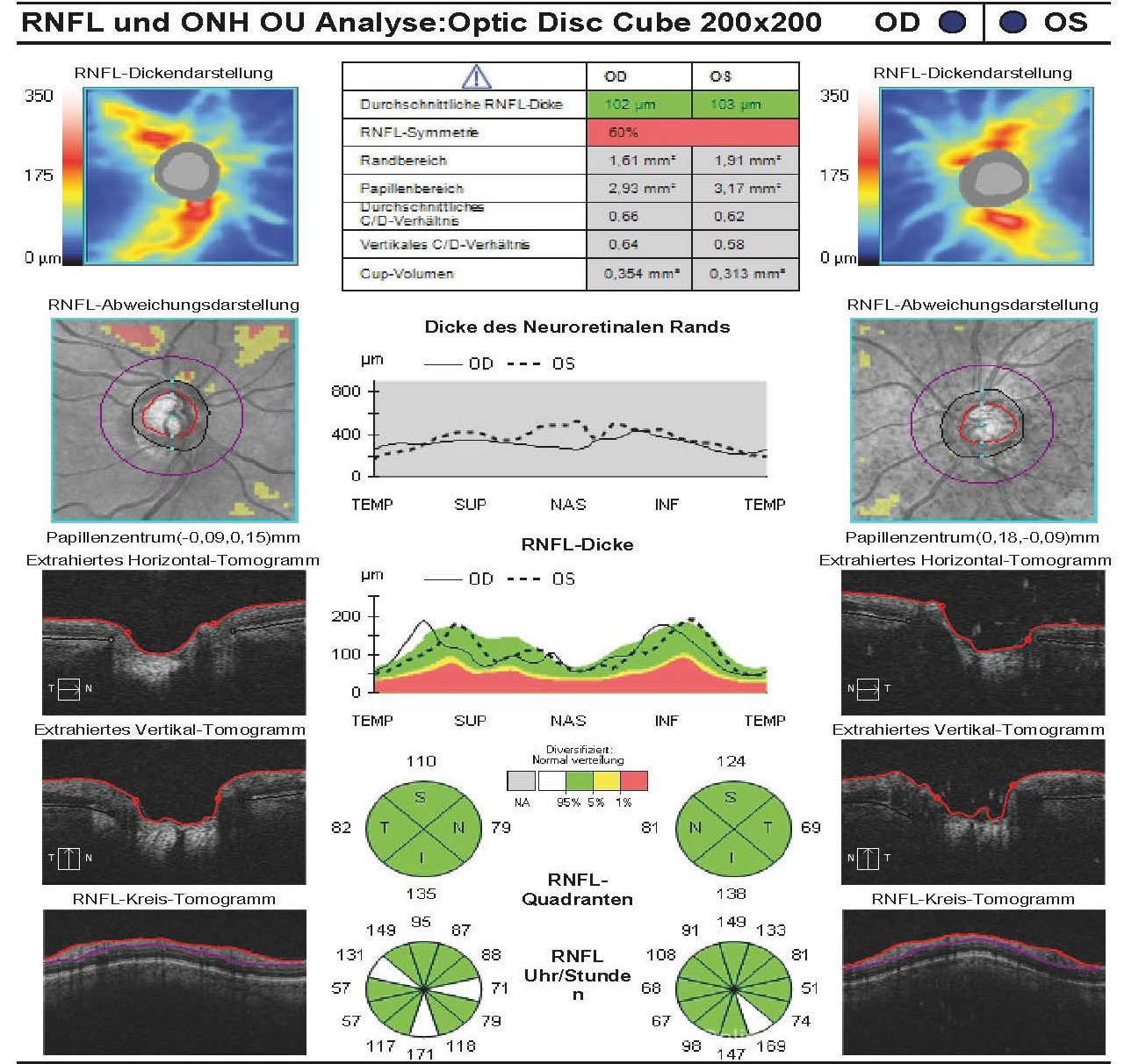 Makropapille | Atlas der Augenheilkunde