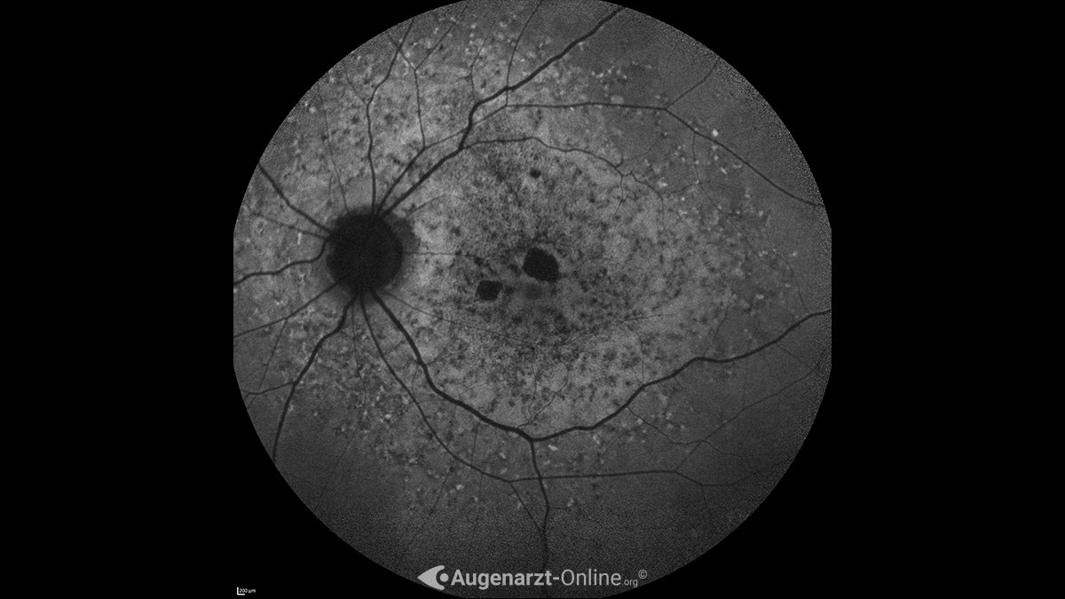 Krankheiten, Morbus Stargardt, 26ecc8c4-1ed1-459b-8aa1-97a935e4e5e1