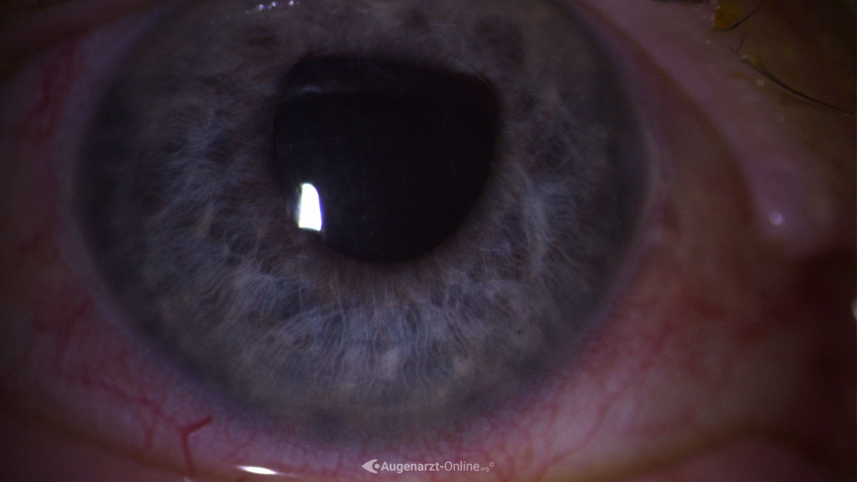 Pupillary Capture | Atlas der Augenheilkunde