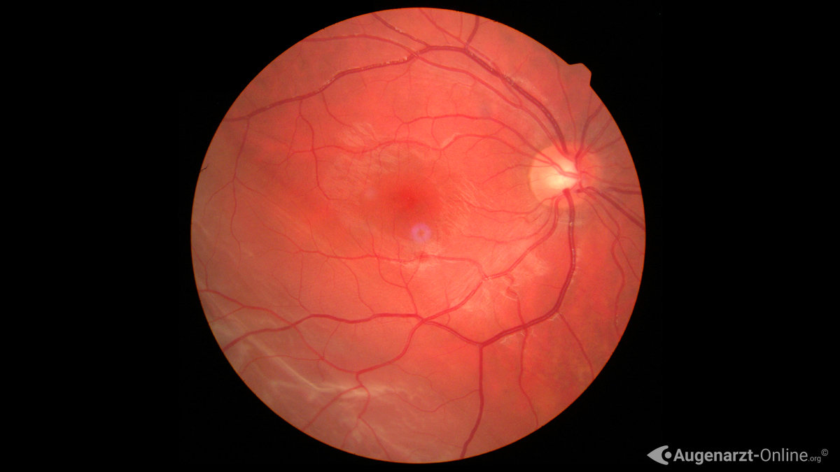 Ablatio retinae | Atlas der Augenheilkunde