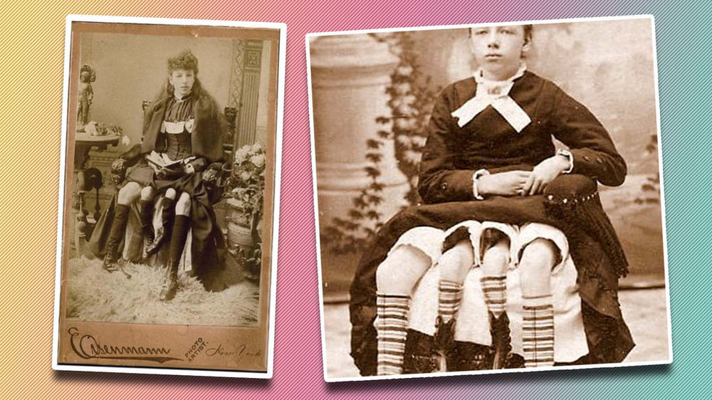 Myrtle Corbin: Four-legged woman and 'freak show' icon
