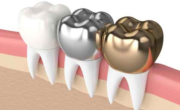 Crowns | Silsoe Dental Clinic