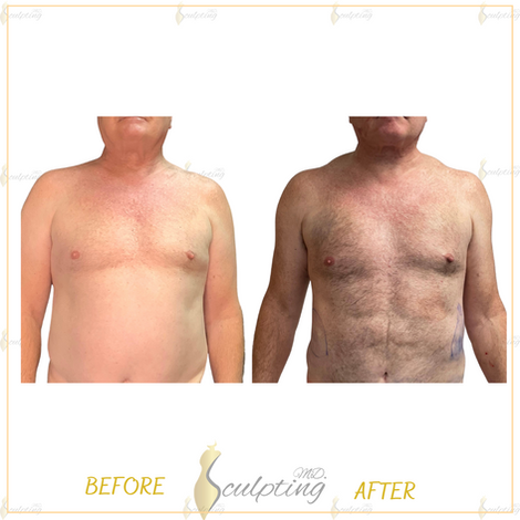 Lipo Gallery | Sculpting MD