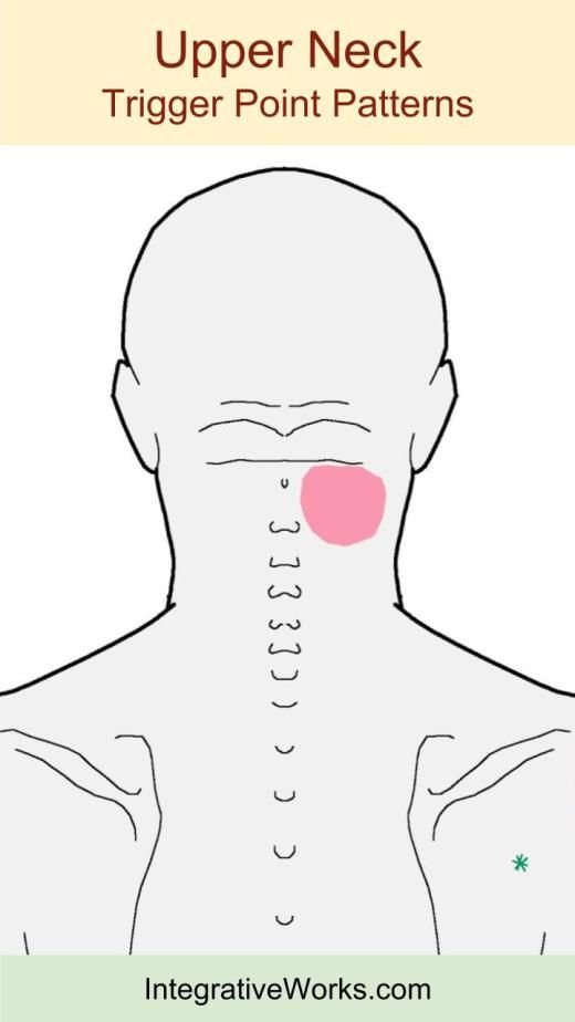 Understanding Trigger Points