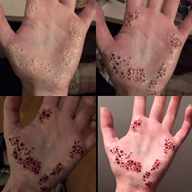 Trypophobia Skin Disease Pictures Outlet UK | www.micoope.com.gt