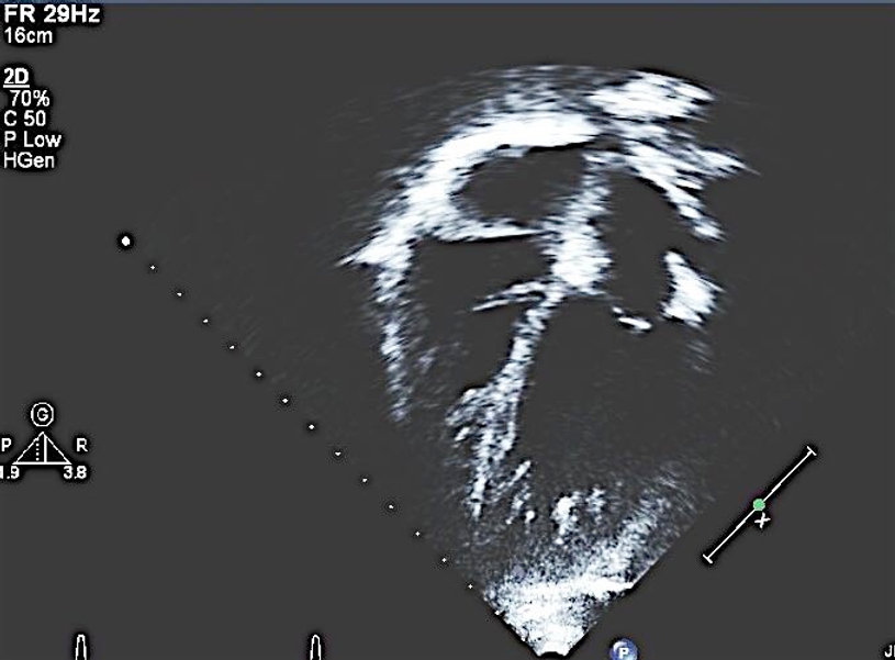 Non-Compaction Cardiomyopathy in a Patient with Holt-Oram Syndrome: A ...