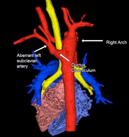 Vascular Ring with Unique Anatomical Variant Elucidated Using 3D Technology