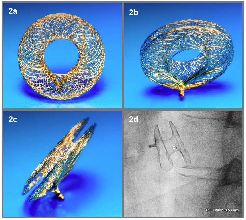 Occlutech Atrial Flow Regulator to Treat Right Ventricular Failure in ...