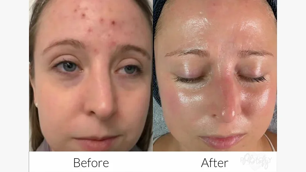 Microneedling Costs Revealed: What You Need to Know