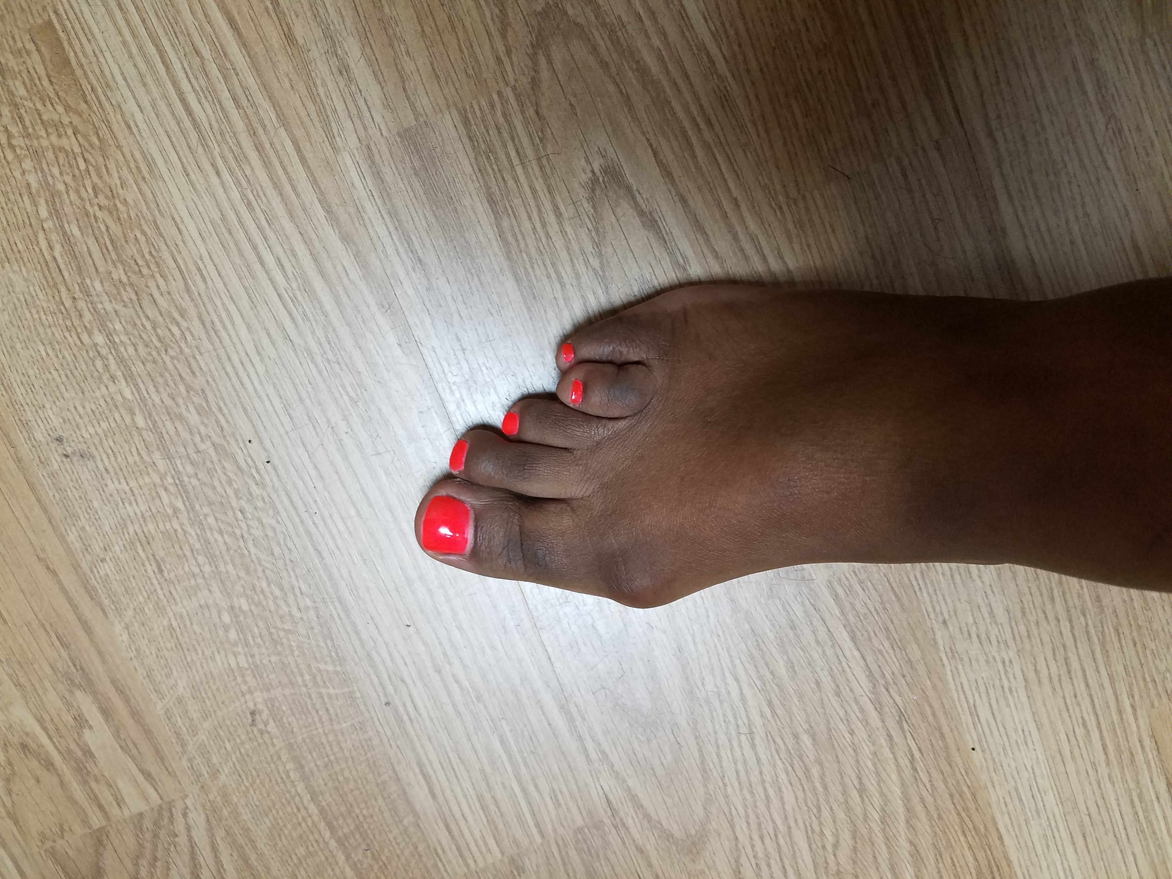 Brachymetatarsia|Foot Health|Montgomery