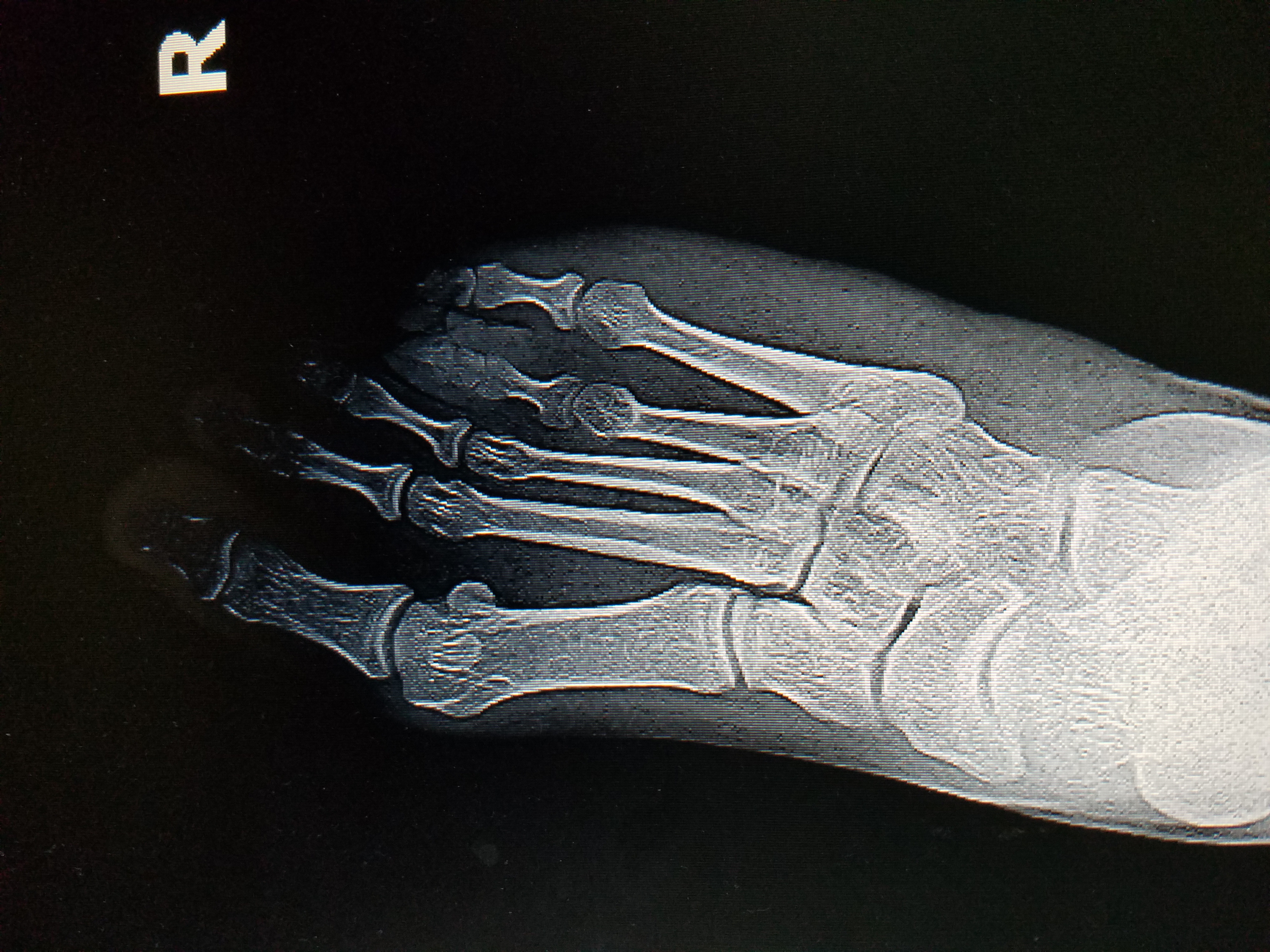 Brachymetatarsia|Foot Health|Montgomery