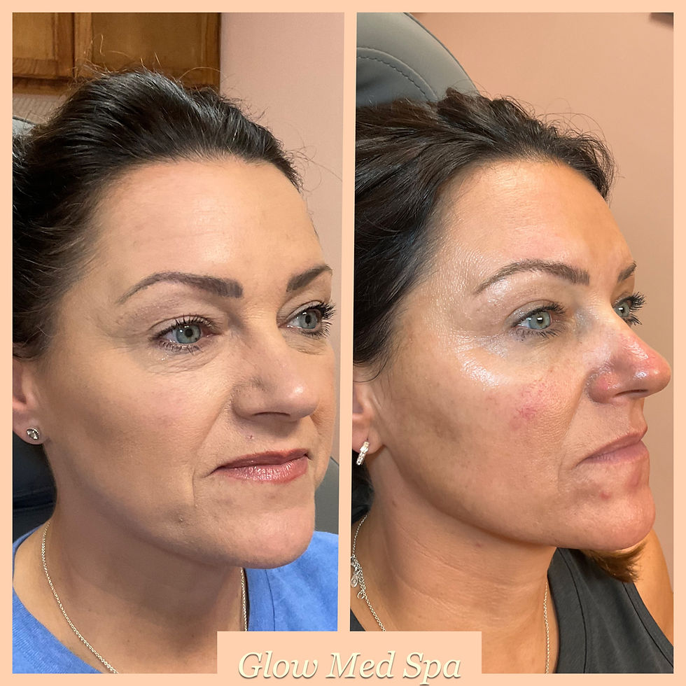 BEFORE AND AFTER | Glow MedSpa&Wellness