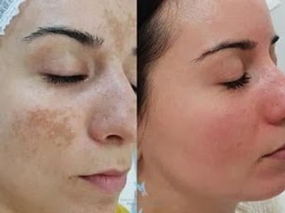 Nano piel / nanopiel / nano piel para el acne colombia y ecuador