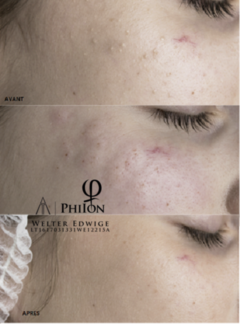 Grain de Milium - Phi Ion, plasma pen.