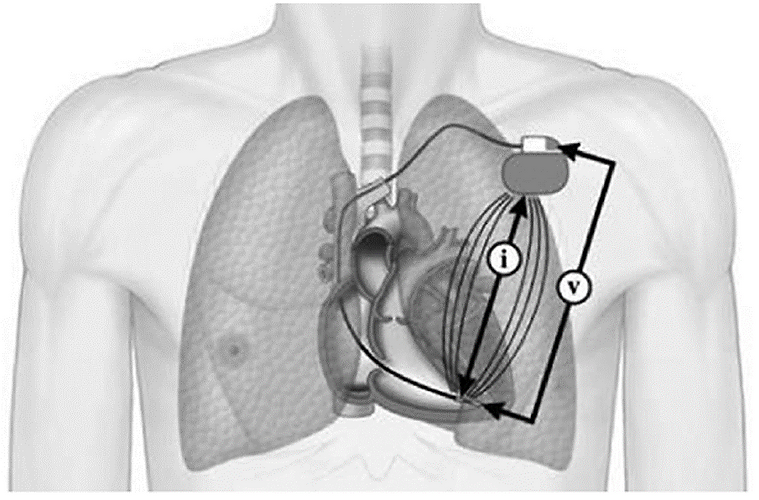 Boston Scientific | Rate Responsive Programming