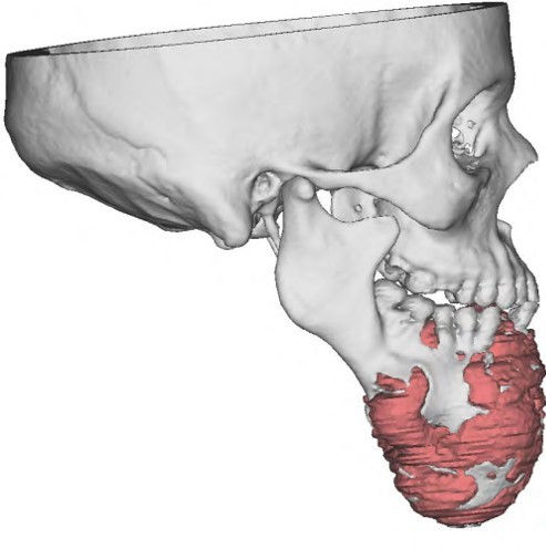How are jaw tumors diagnosed?