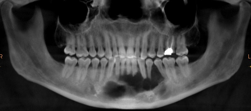 How are jaw tumors diagnosed?