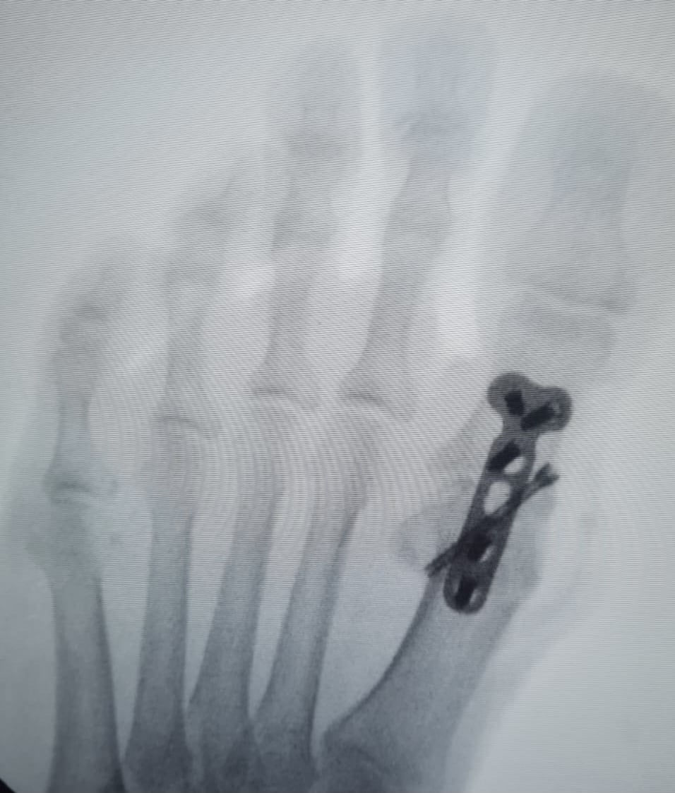 Artrodeses do Pé e Tornozelo: O que é?