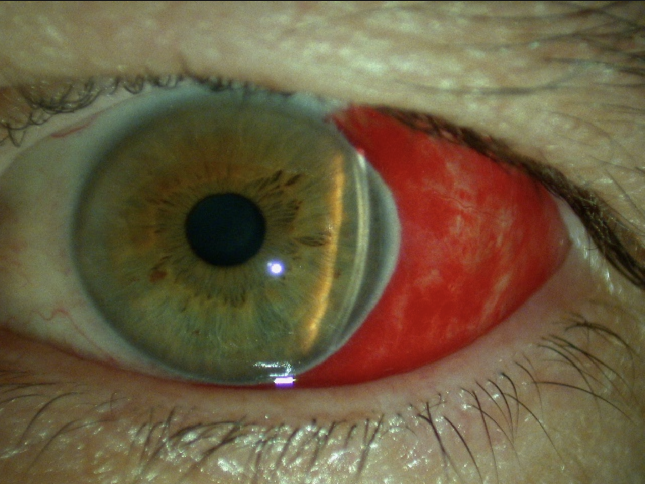 Pathologies | Hémorragie sous conjonctivale | Dr Facon