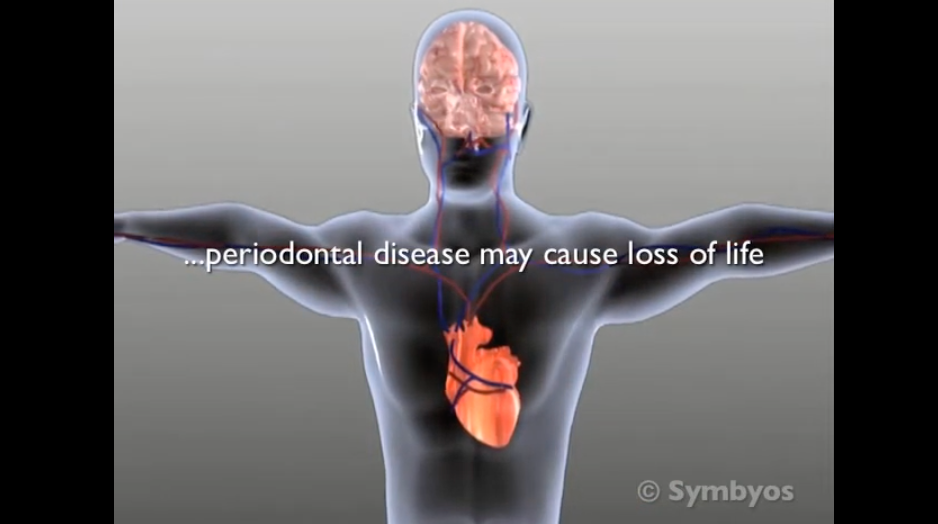 Body And Mouth Connection | Premier Periodontics
