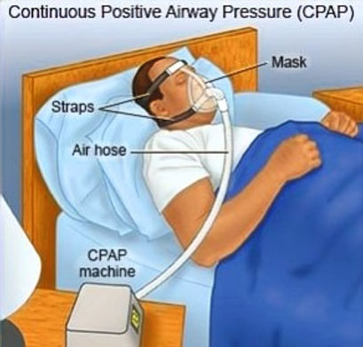 CPAP for Sleep Apnea. *7 things to know for a CPAP user to breath ...